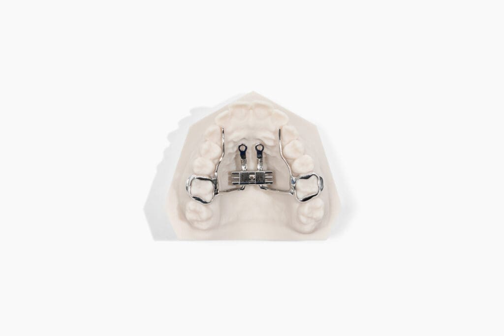 MARPE Expander: A Complete Guide to Modern Palatal Expansion Treatment ...