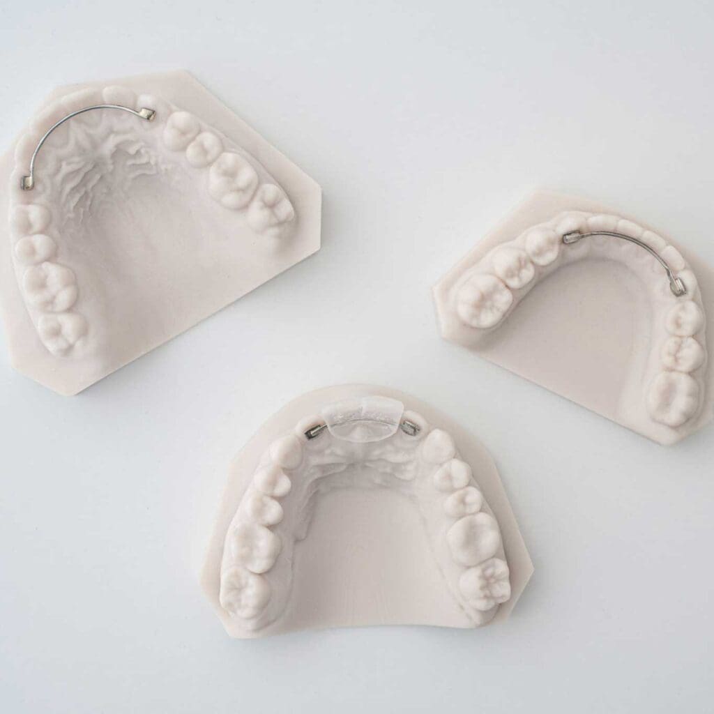 Fixed Lingual Retainers | ODL Orthodontic Labs