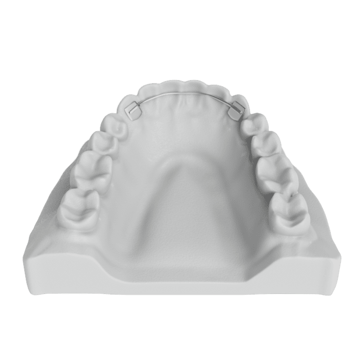 Fixed Lingual Retainers | ODL Orthodontic Labs