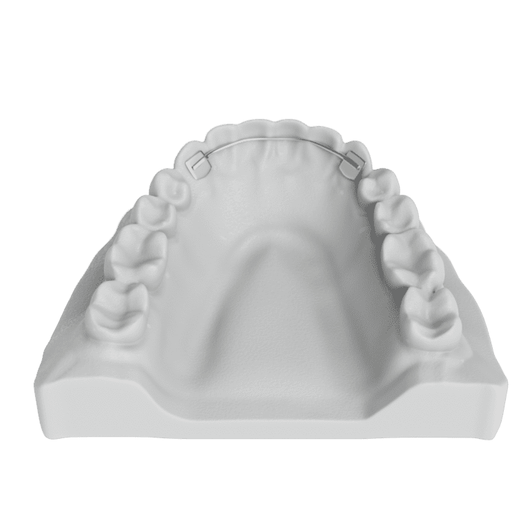 Fixed Lingual Retainers | ODL Orthodontic Labs