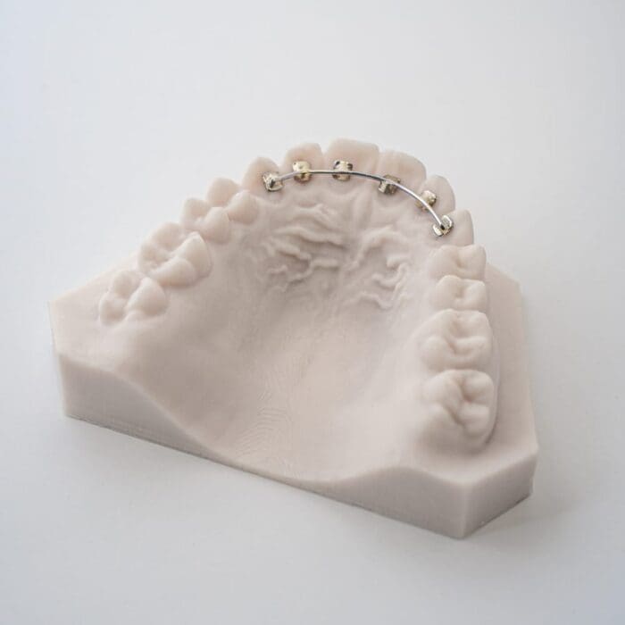 Leaf Spring Self Activated Expander | ODL Orthodontic Labs