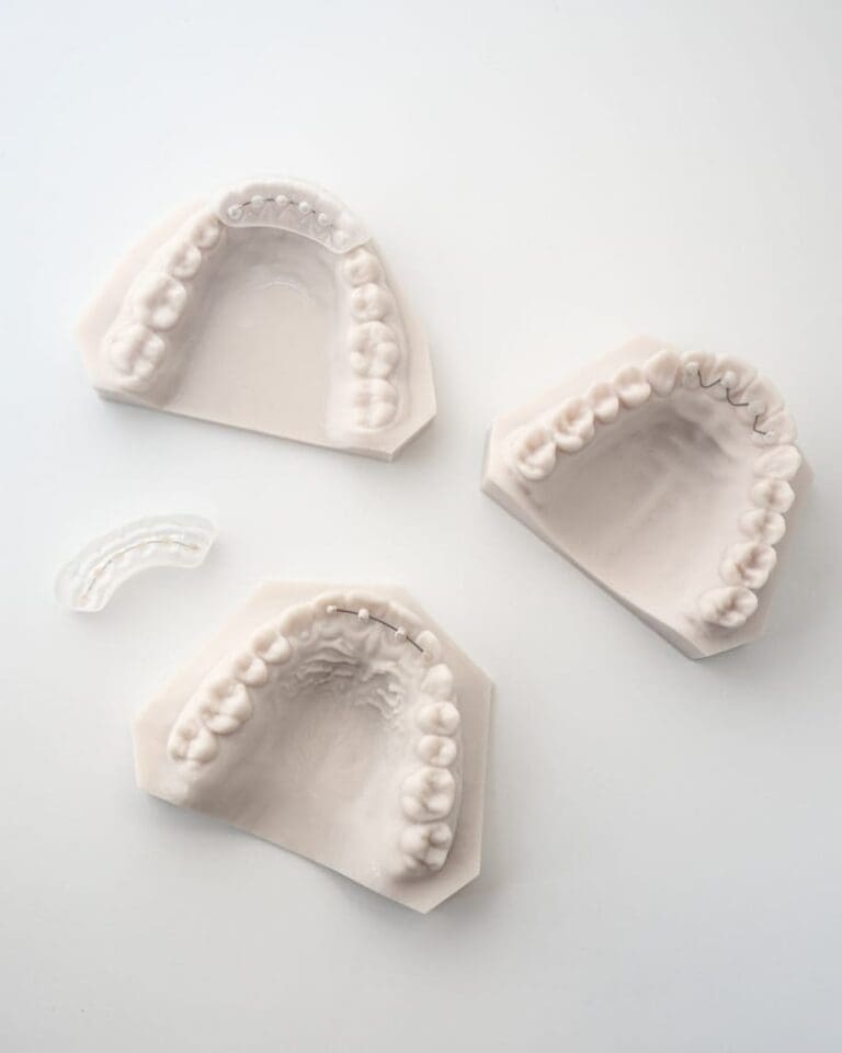 Fixed Lingual Retainers | ODL Orthodontic Labs
