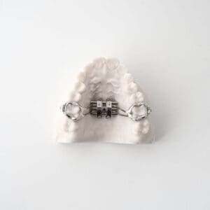 TAD Appliances for Airway Expansion | ODL Orthodontic Labs
