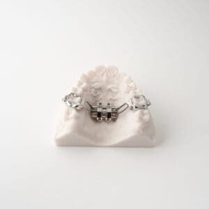 TAD Appliances for Airway Expansion | ODL Orthodontic Labs