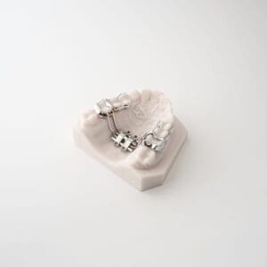 TAD Appliances for Airway Expansion | ODL Orthodontic Labs