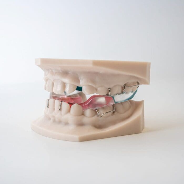 Theroux Phase 1 Retainer | ODL Orthodontic Labs