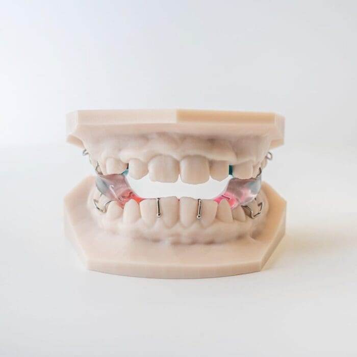 Theroux Phase 1 Retainer | ODL Orthodontic Labs