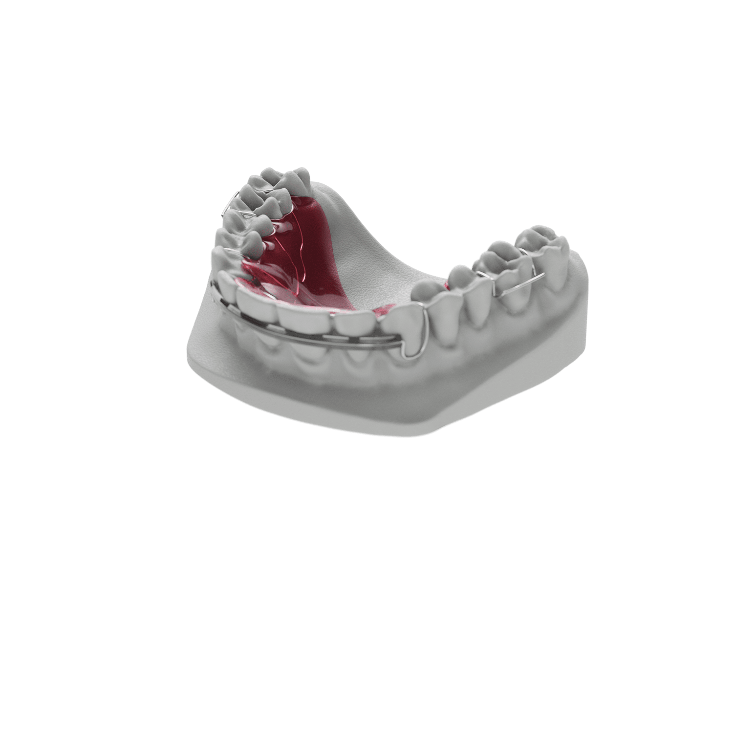 Super Spring Aligner | ODL Orthodontic Labs