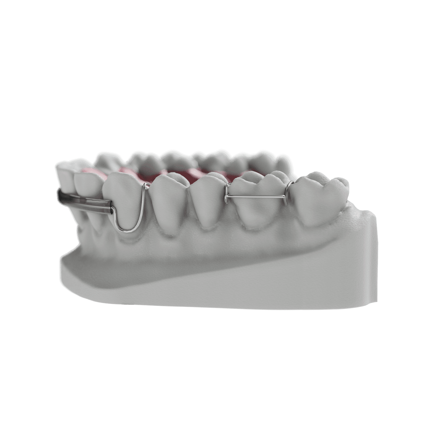 Super Spring Aligner | ODL Orthodontic Labs