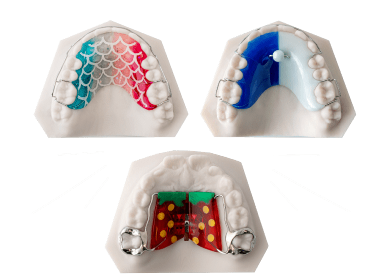 MARPE Expander: A Complete Guide to Modern Palatal Expansion Treatment ...