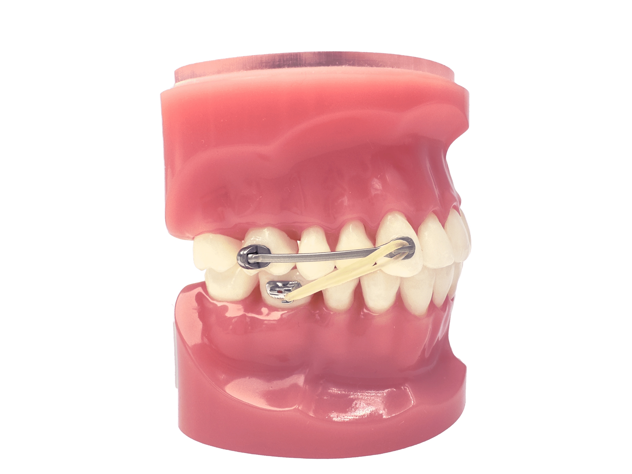 Decoding the Success of the Class II Corrector in Treating Bite ...